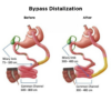 Bypass Distalization | Revision Weight Loss Surgery | Blossom Bariatrics